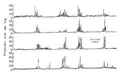 Manometria anorrectal - Proctología